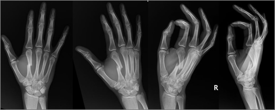 Use of NX Nail for oblique fracture fixation of 2nd metacarpal